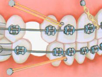Mini-Implants Or Mini-Screws For Orthodontics