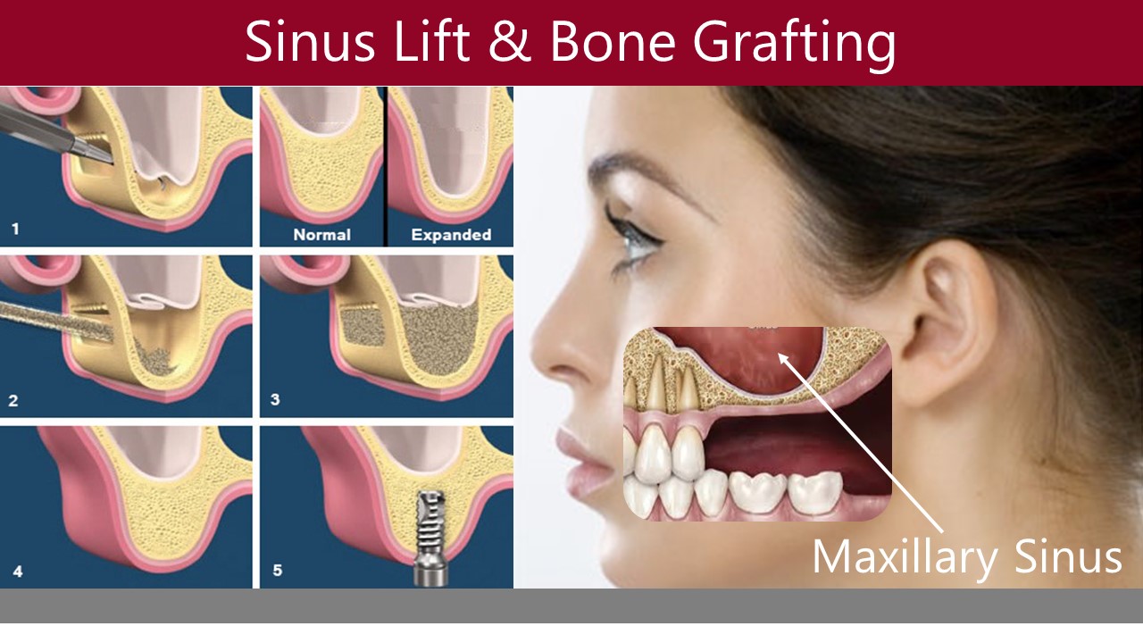 Sinus Lift